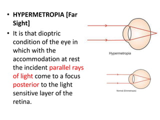 Refrective error (opthalmology) | PPTX
