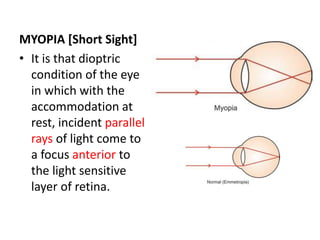 Refrective error (opthalmology) | PPT