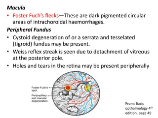 Refrective error (opthalmology) | PPT