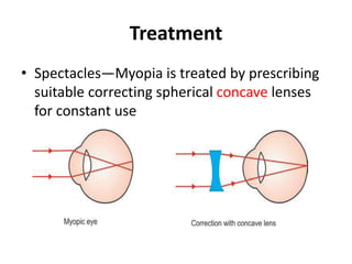 Refrective error (opthalmology) | PPT