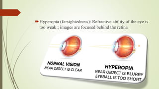 Refrective error | PPTX | Eye and Vision Conditions | Diseases and ...
