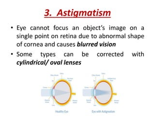 REFRECTIVE ERRORS.pptx refraction errors | PPTX