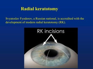 Radial Keratotomy