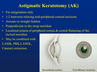 Astigmatic Keratotomy