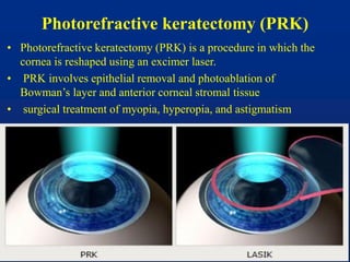 Photorefractive Keratectomy