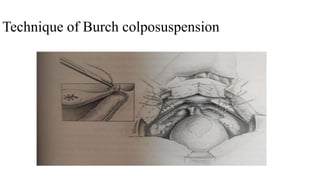refreshed laparoscopic burch colposuspension.pptx