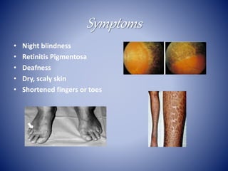 Refsum disease | PPTX