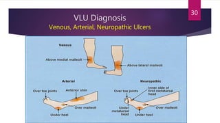 Epidermal Growth Factor use in Venous Leg Ulcers, Pressure Ulcers ...