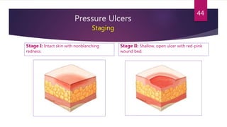 Epidermal Growth Factor use in Venous Leg Ulcers, Pressure Ulcers ...