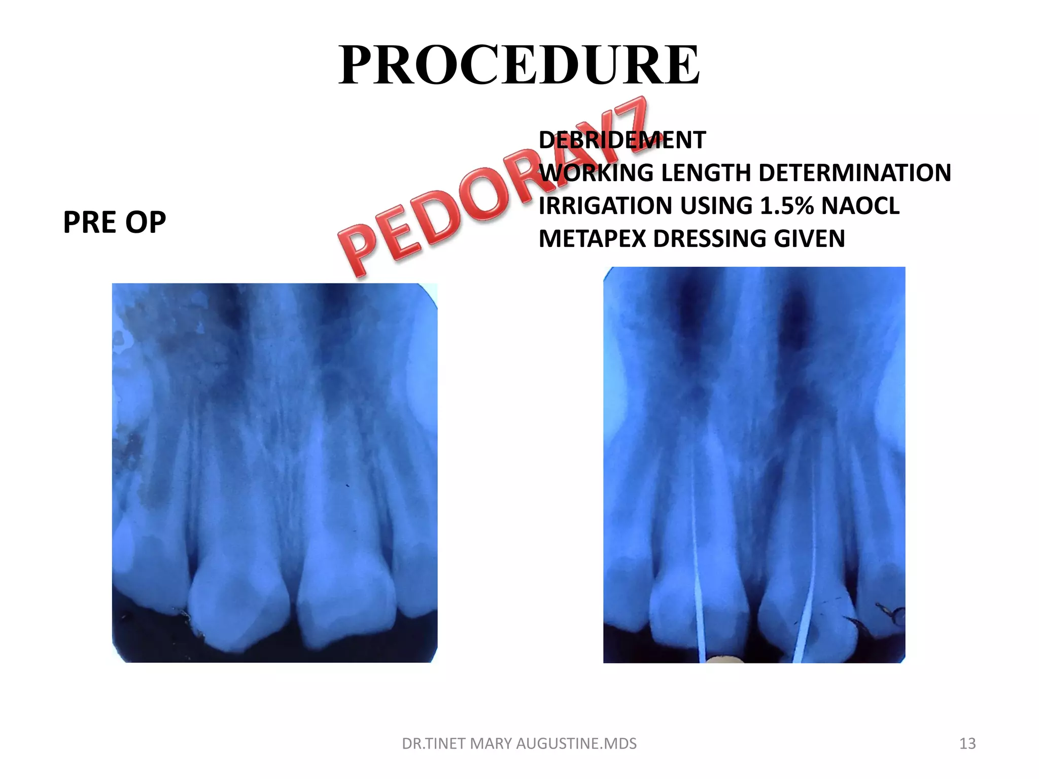 Regenerative endodontics. basic and case report | PDF