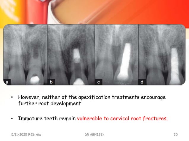 Regenerative endodontics | PPTX | Dental Health | Diseases and Conditions