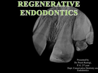 Regenerative endodontics | PPTX