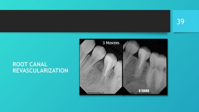 Regenerative endodontics_ ENDODONTICS REVIEW | PPTX | Dental Health ...