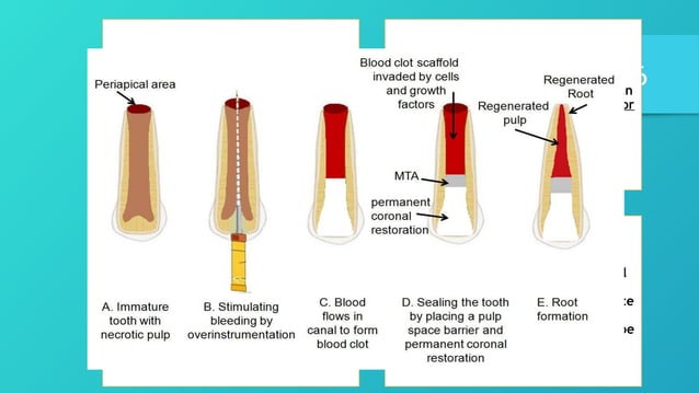 Regenerative endodontics_ ENDODONTICS REVIEW | PPTX | Dental Health ...