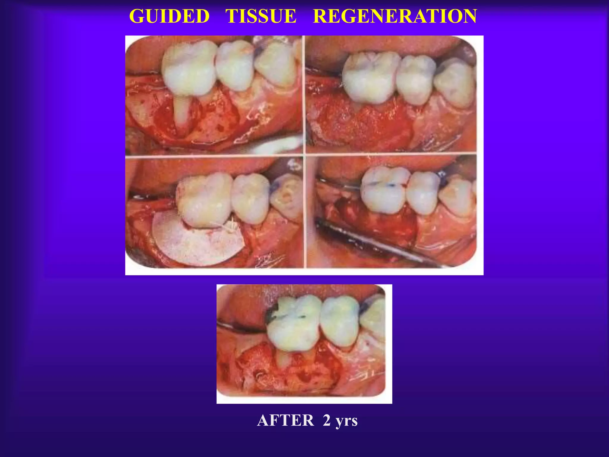 REGENERATIVE OSSEOUS SURGERY.ppt