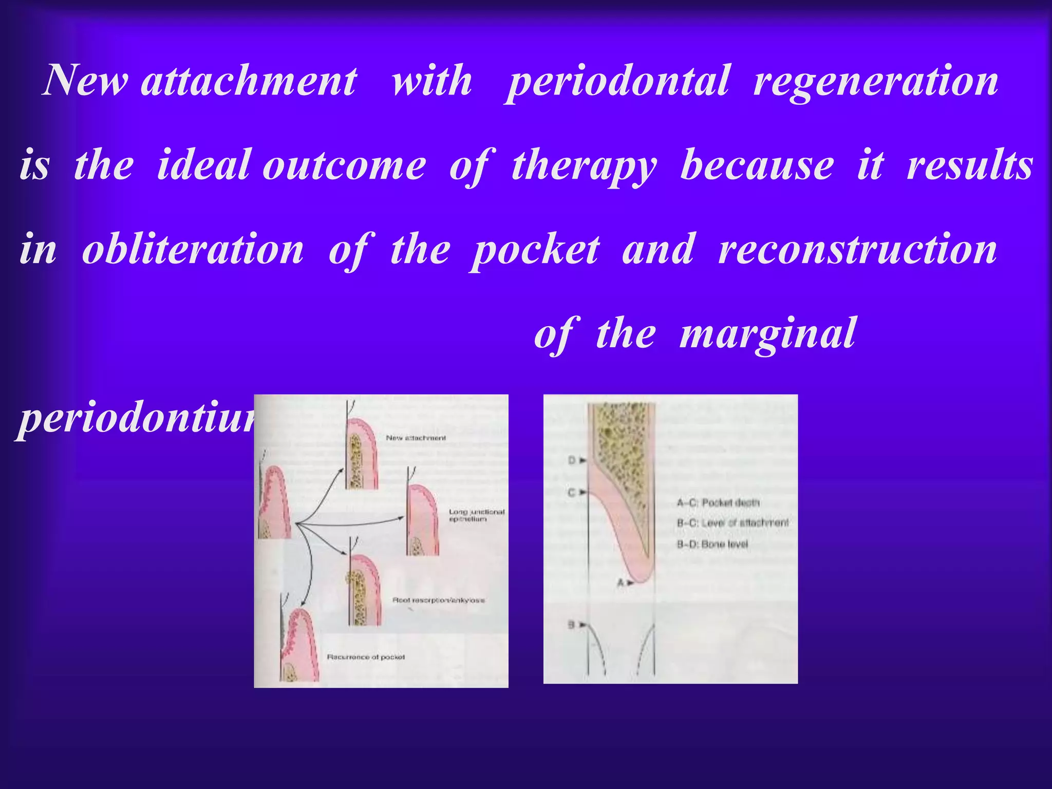 REGENERATIVE OSSEOUS SURGERY.ppt