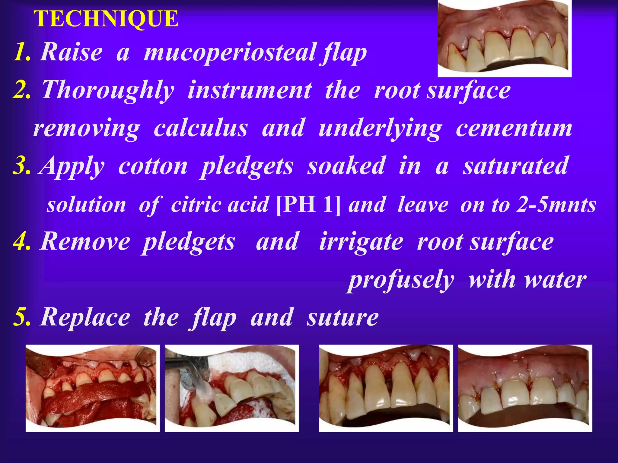 REGENERATIVE OSSEOUS SURGERY.ppt