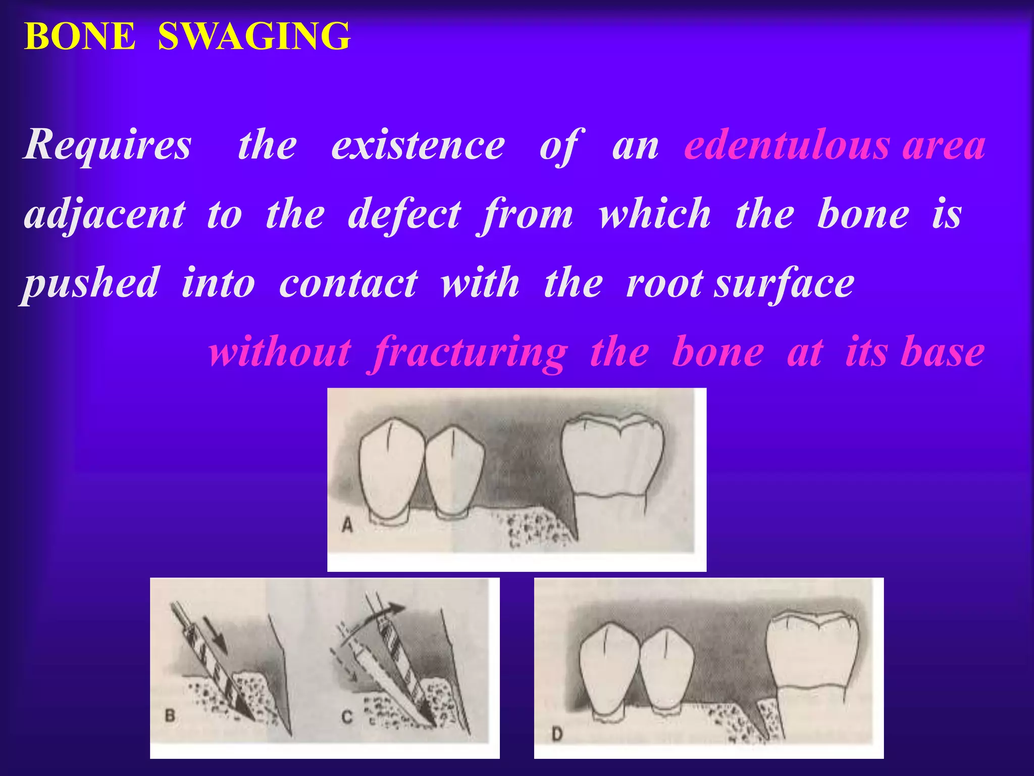 REGENERATIVE OSSEOUS SURGERY.ppt