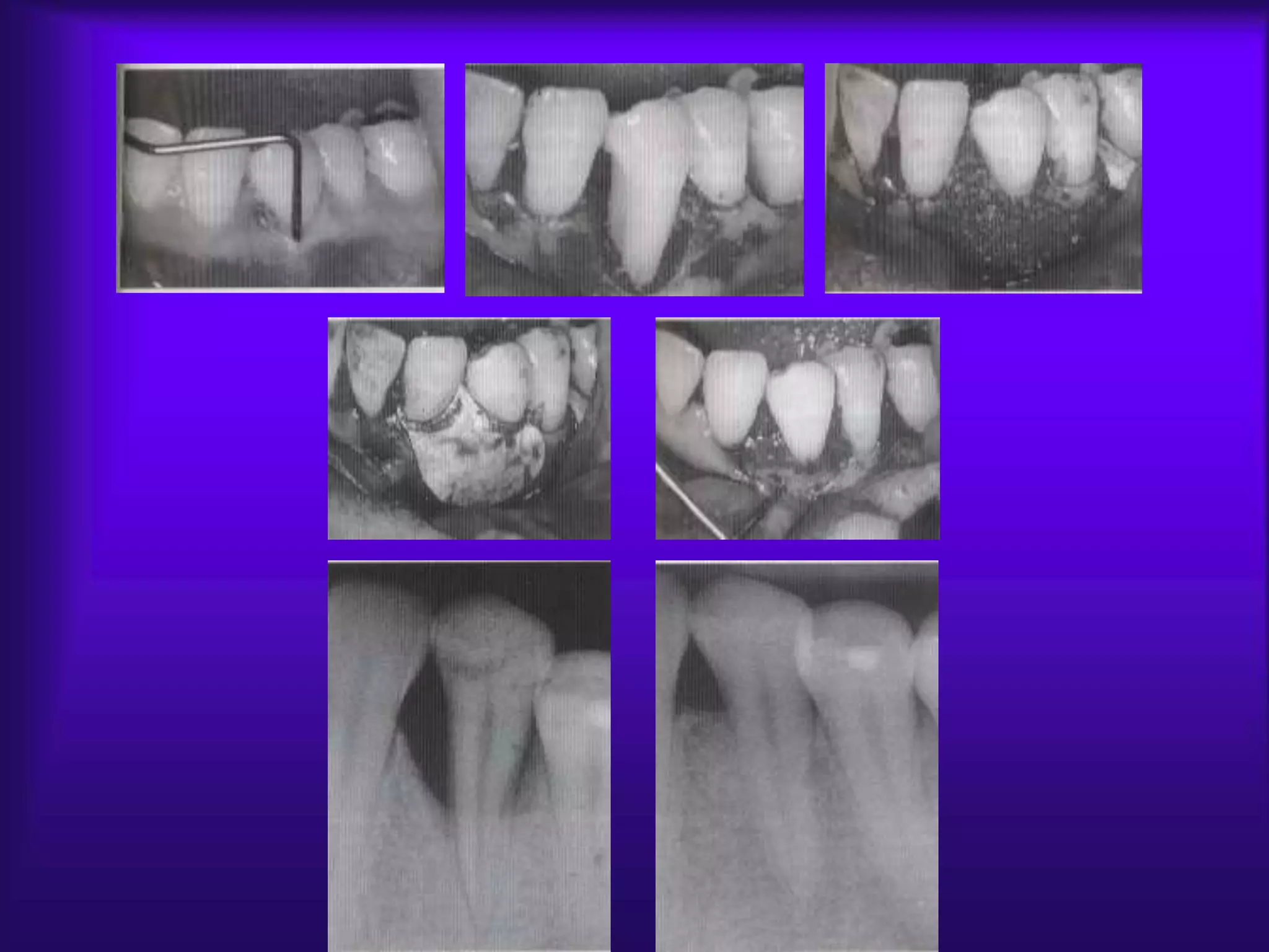 REGENERATIVE OSSEOUS SURGERY.ppt