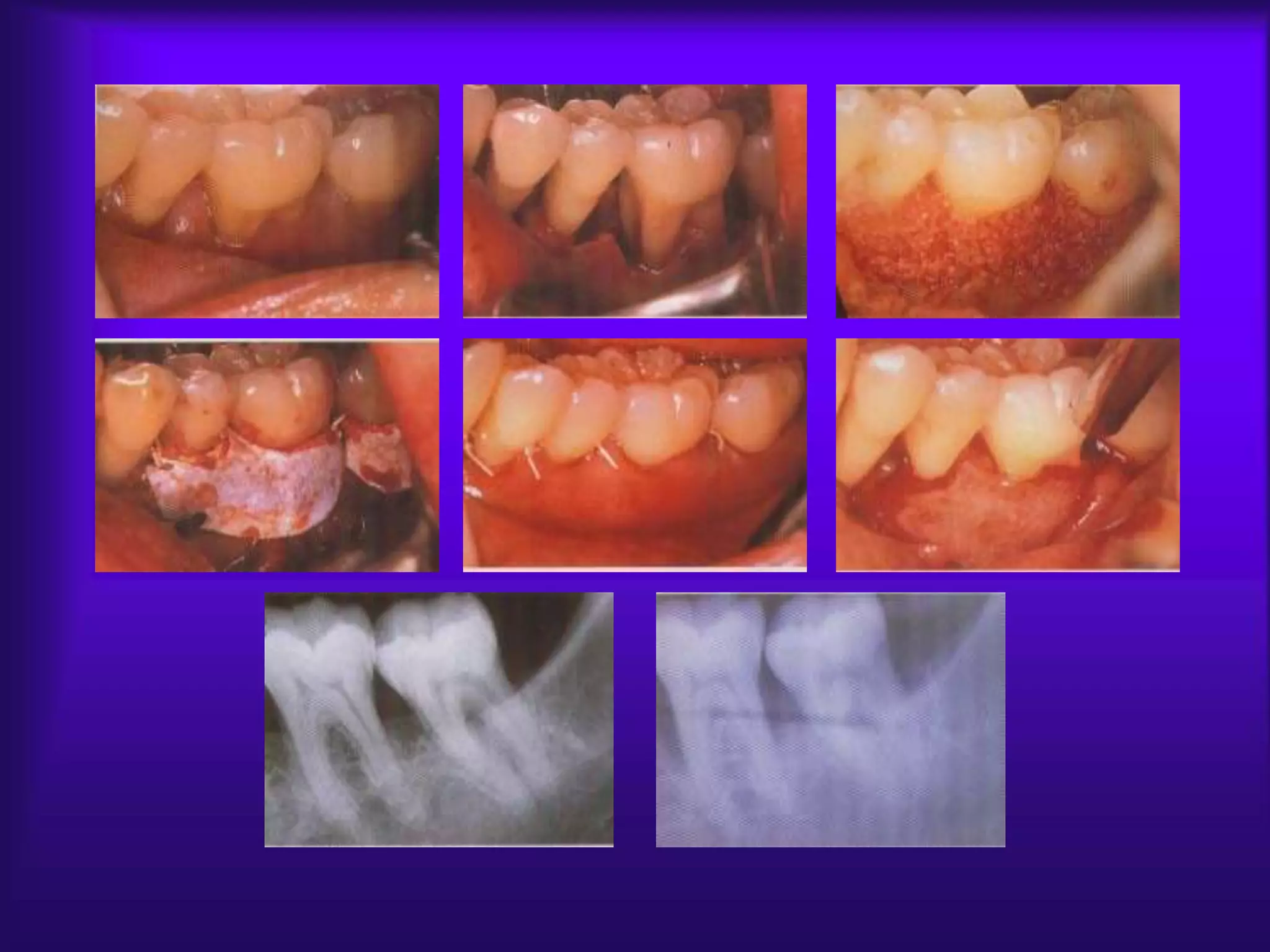 REGENERATIVE OSSEOUS SURGERY.ppt