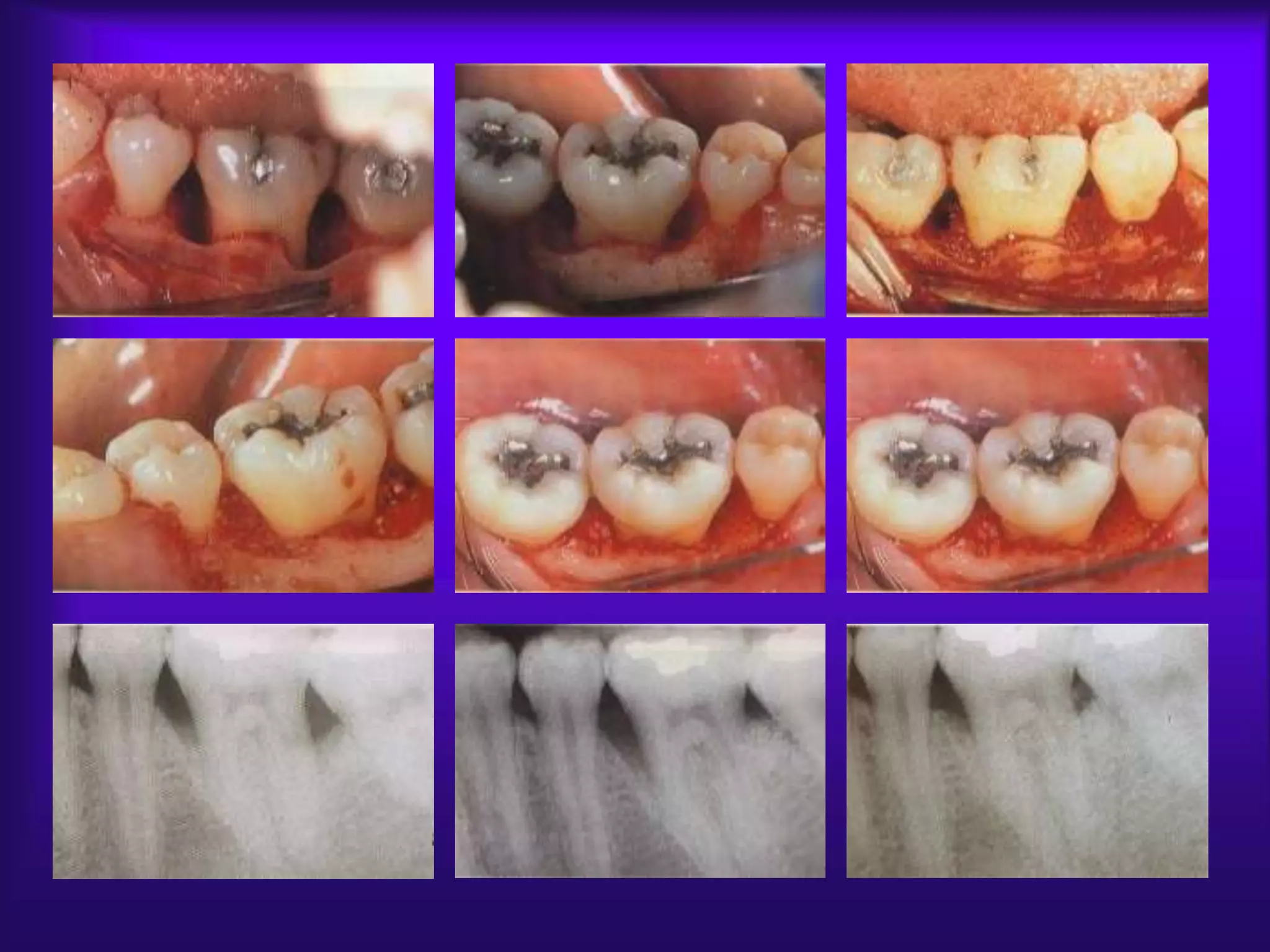 REGENERATIVE OSSEOUS SURGERY.ppt