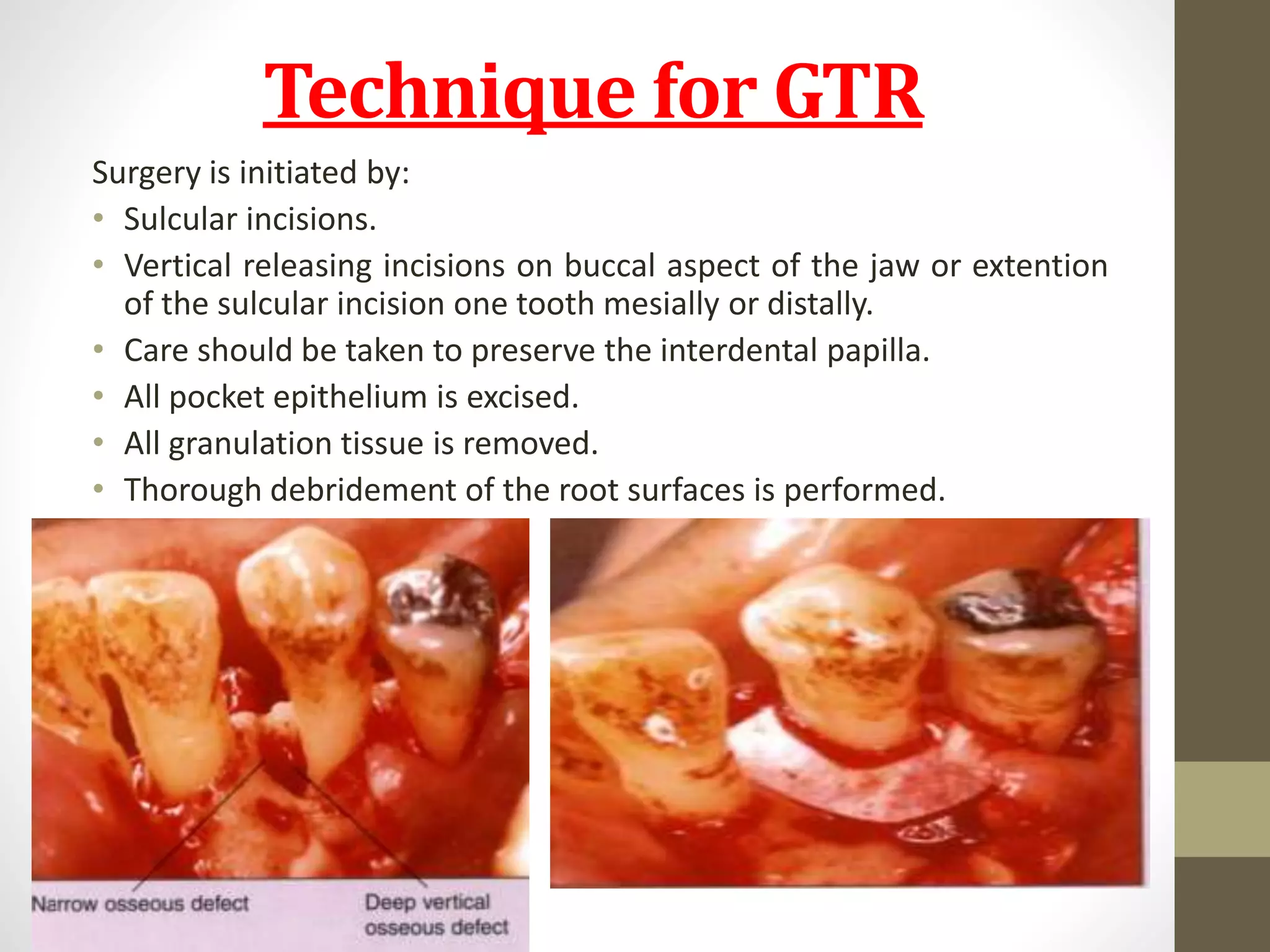 Regenerative techniques for periodontal therapy | PPTX
