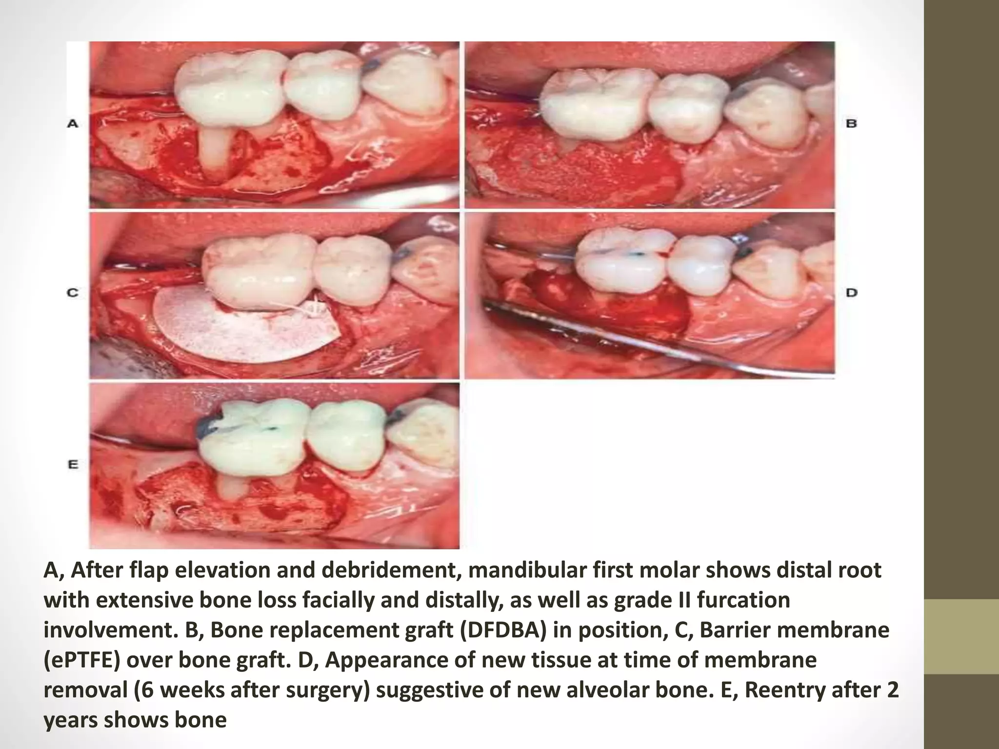 Regenerative techniques for periodontal therapy | PPTX