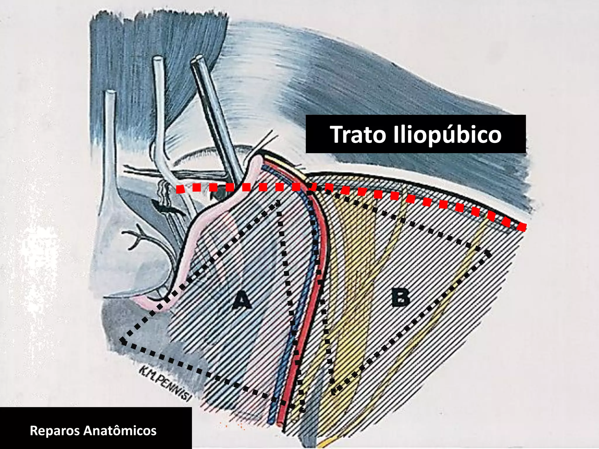 Anatomia Topográfica da Região Inguinal | PDF