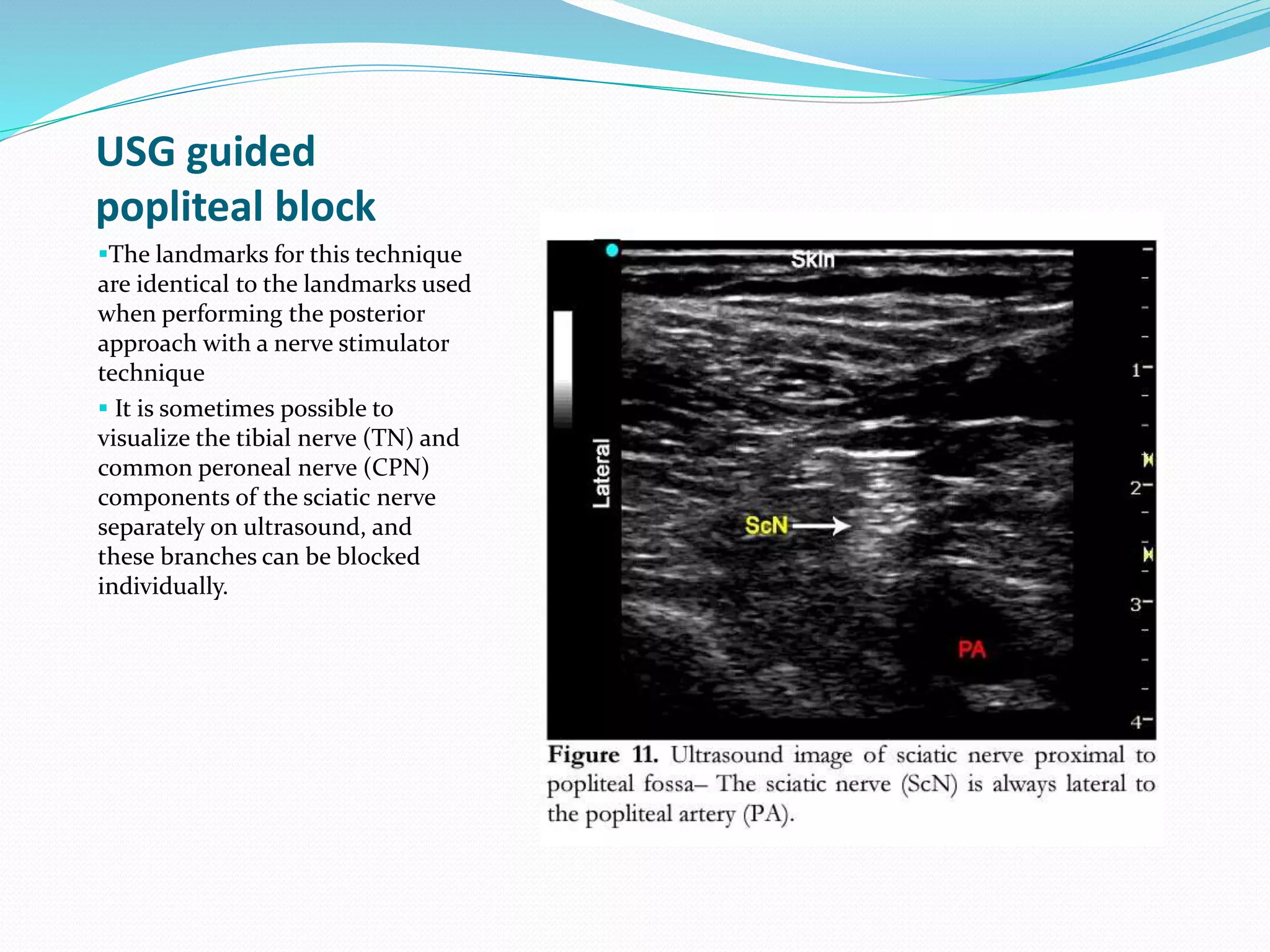 Regional anaesthesia lower limb blocks | PPTX