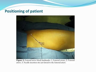 Regional anaesthesia lower limb blocks | PPTX