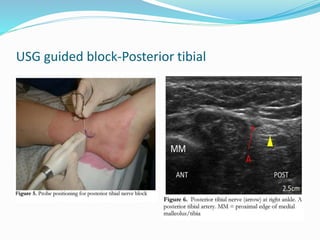 Regional anaesthesia lower limb blocks | PPTX