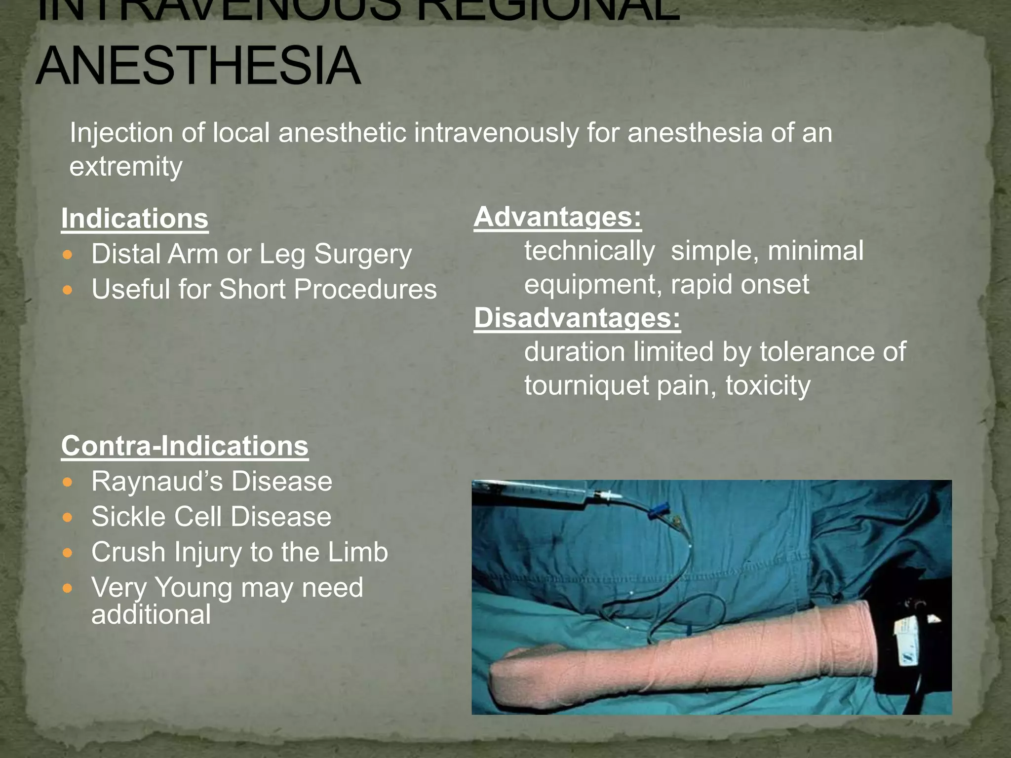 Regional anesthesia | PPTX
