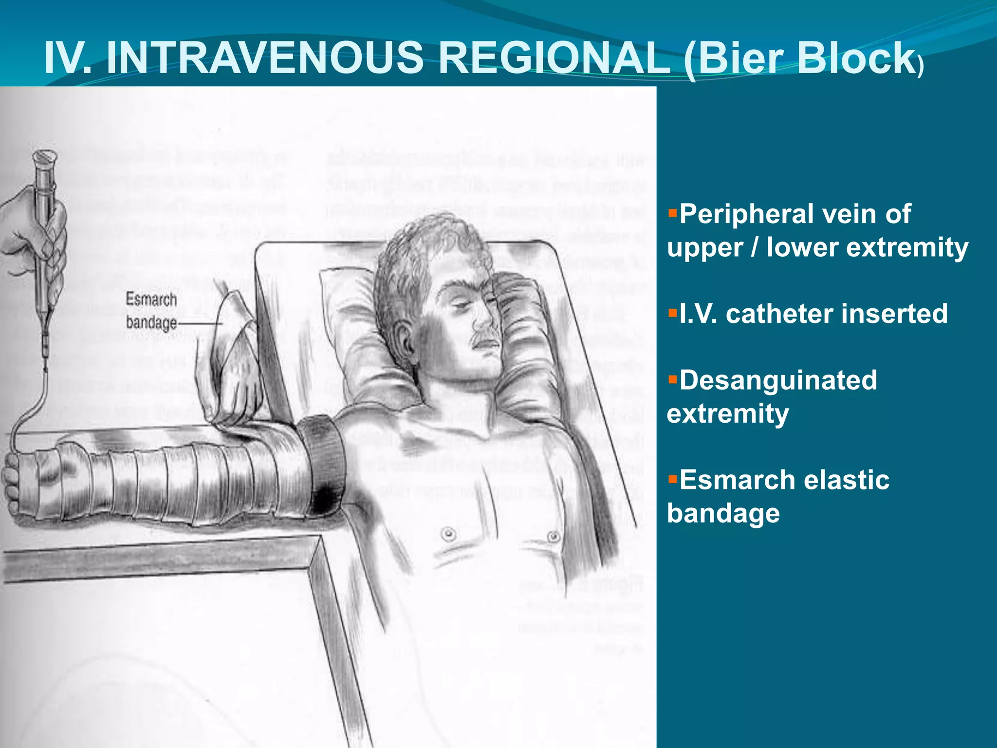 Regional anesthesia | PPTX