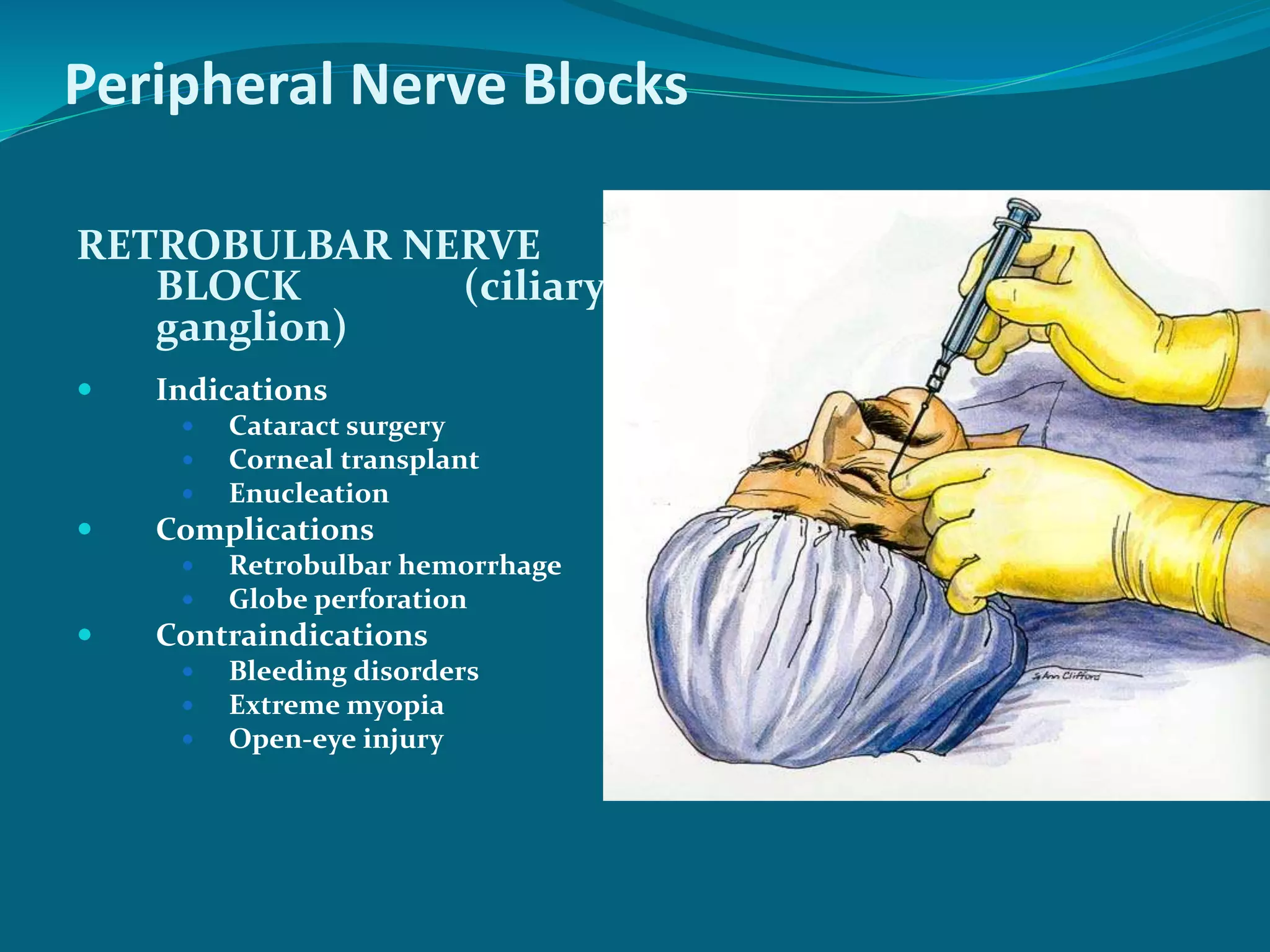 Regional anesthesia | PPTX