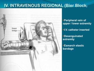 Regional anesthesia | PPTX