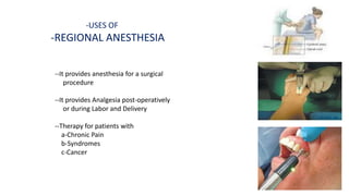 #Regional anesthesia | PPTX