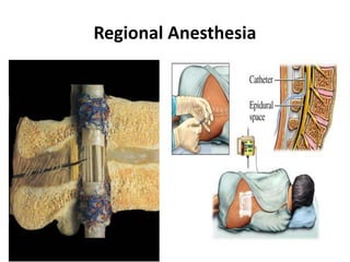 Regional anesthesia | PPTX