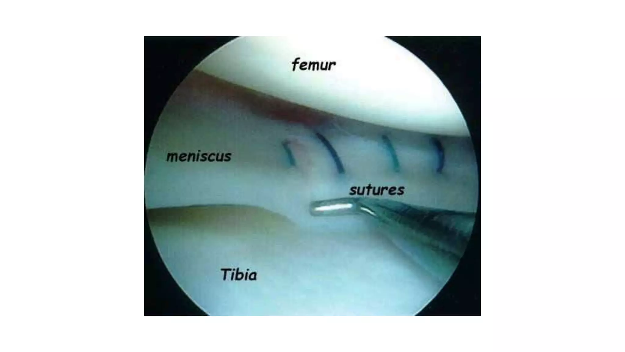 Ligamentous Injuries Around Knee by Dr Arun C Raj, Ortho Resident, KIMS ...