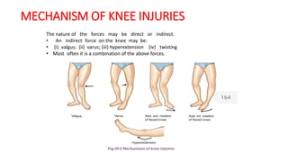 Ligamentous Injuries Around Knee by Dr Arun C Raj, Ortho Resident, KIMS ...