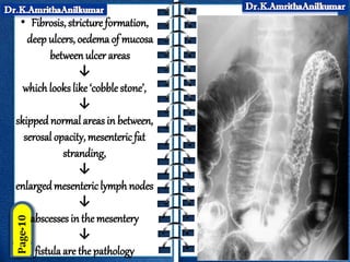 Regional enteritis (crohn’s disease) by Dr.AmrithaAnilkumar | PPT
