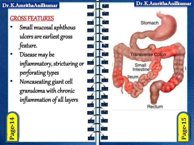 Regional enteritis (crohn’s disease) by Dr.AmrithaAnilkumar | PPT