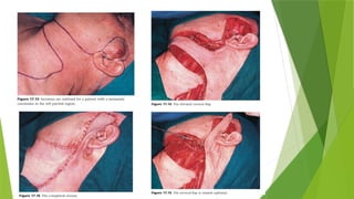 Regional flap Reconstruction in Head & Neck Surgeries | PPTX