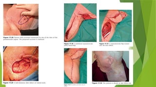 Regional flap Reconstruction in Head & Neck Surgeries | PPTX