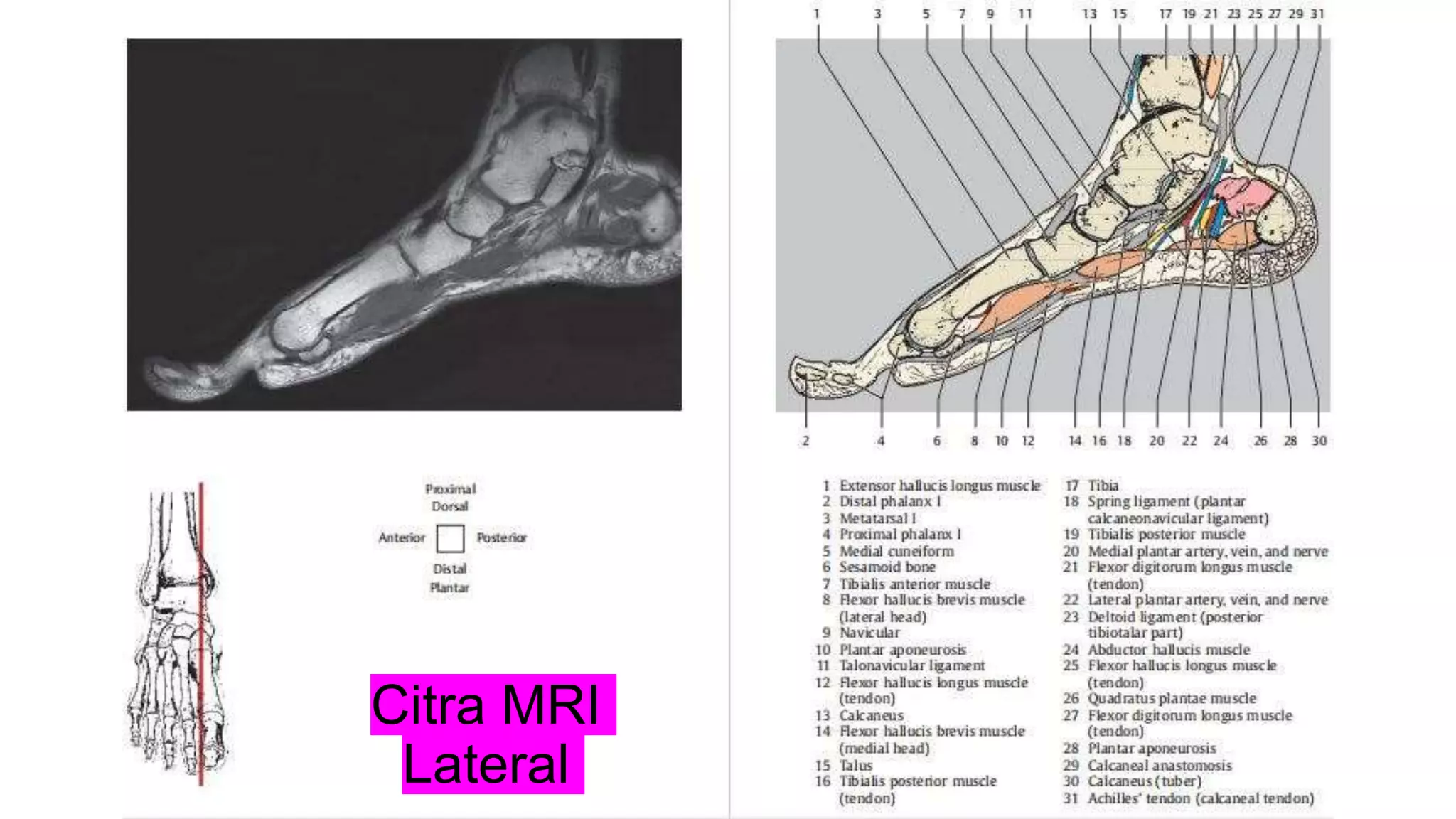 REGIO PEDIS_Inayah Mumpuni B_Harimulti A Wibowo.pptx