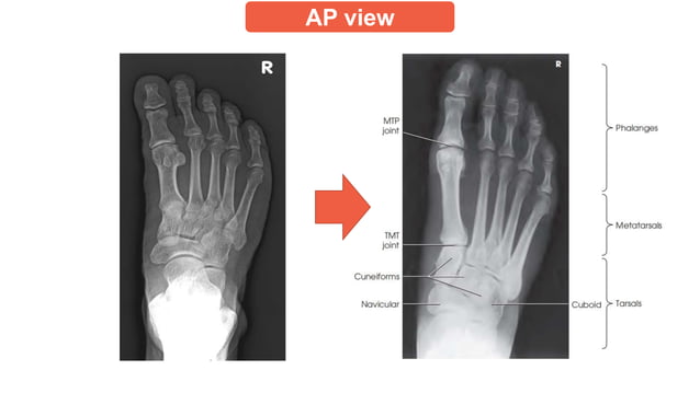 REGIO PEDIS_Inayah Mumpuni B_Harimulti A Wibowo.pptx