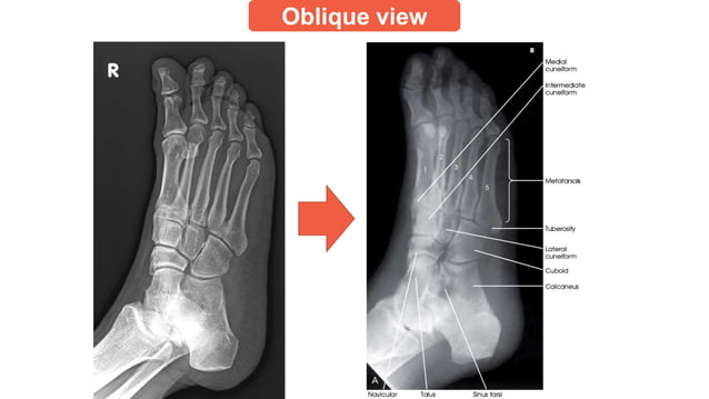 REGIO PEDIS_Inayah Mumpuni B_Harimulti A Wibowo.pptx
