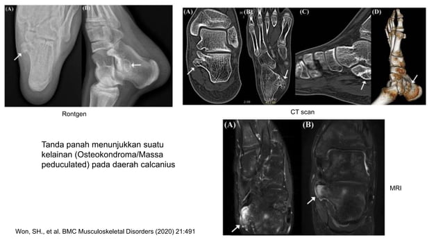 REGIO PEDIS_Inayah Mumpuni B_Harimulti A Wibowo.pptx