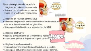 Registro de Mordida de la clase de Oclusión | PPTX