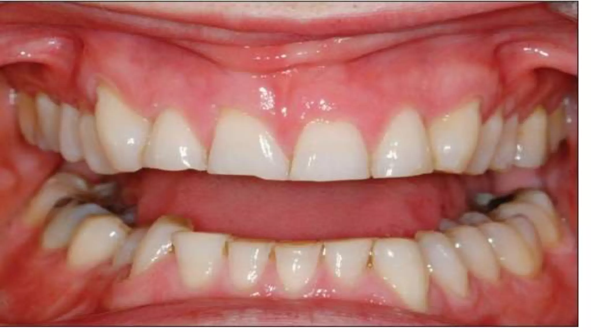 ATTRITION OF TEETH (Regressive Alterations of Teeth) | PPTX
