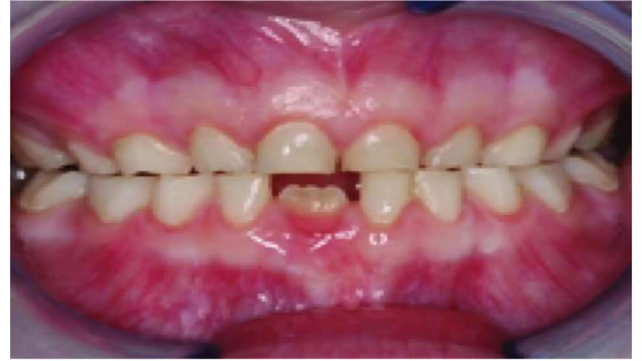 ATTRITION OF TEETH (Regressive Alterations of Teeth) | PPTX